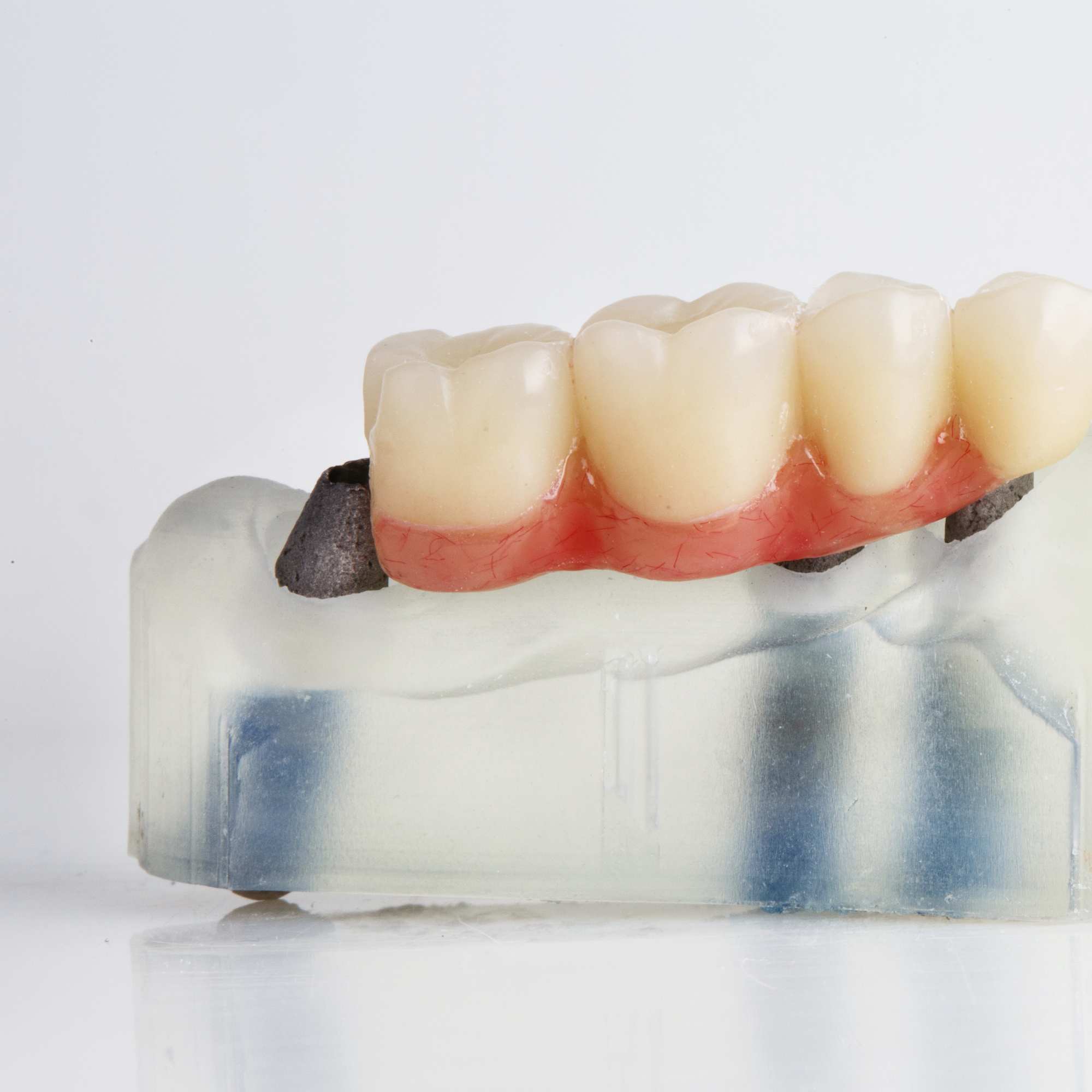 Same Day Dental Bridge – Hands Worth Dental Care